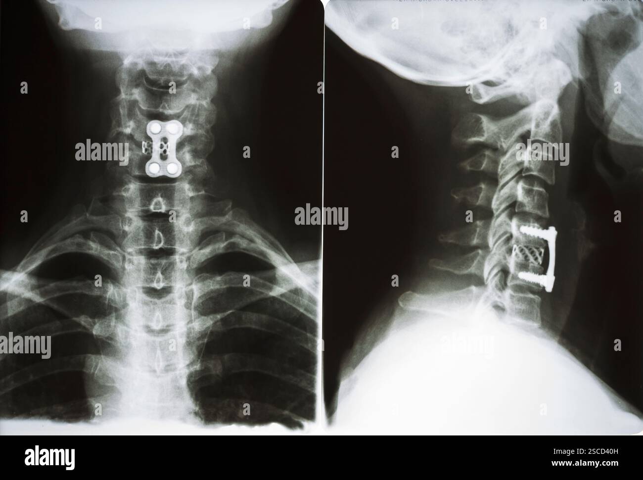 X-ray of a surgical operation on the cervical vertebrae Stock Photo - Alamy