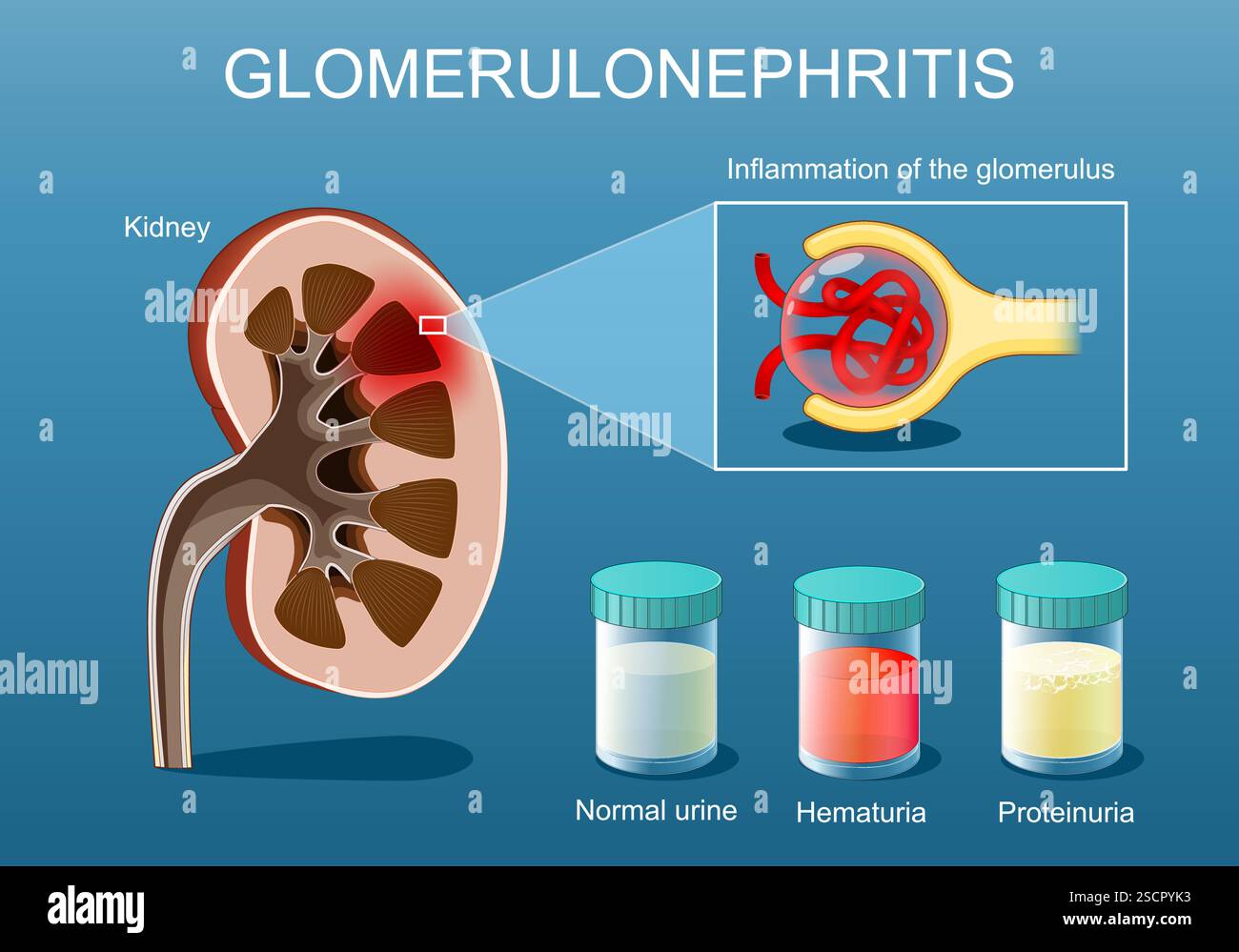 Glomerulonephritis. Cross section of a human kidney. Close-up of ...