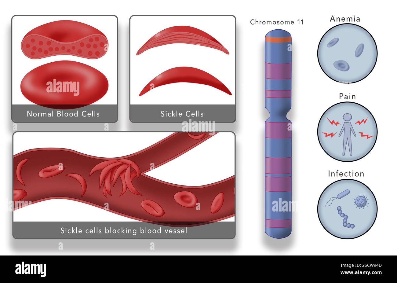 Diagram of sickle cell symptoms hi-res stock photography and images - Alamy