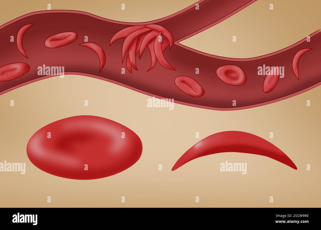 A Normal Blood Cell and a Sickle Cell With a Clogged Artery ...