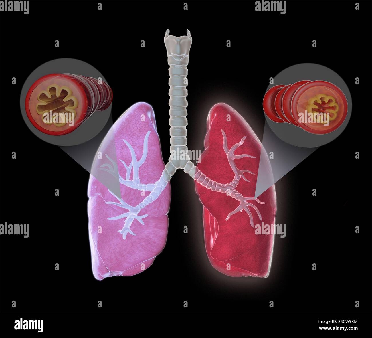 3d illustration showing a healthy airway of the lungs and an airway ...