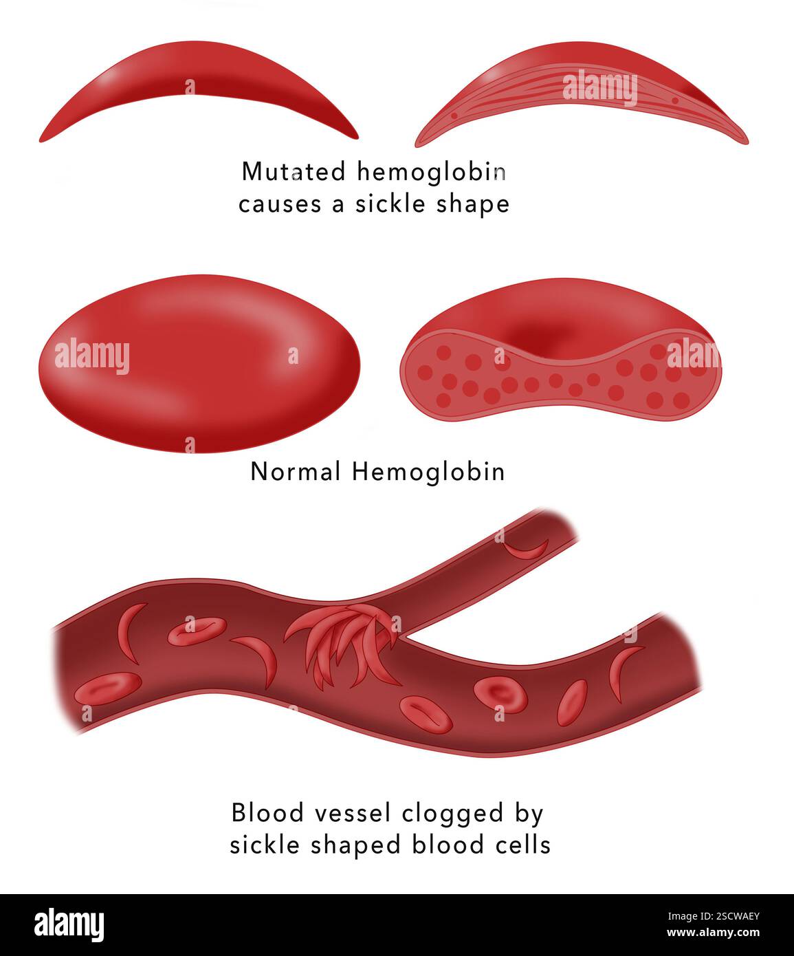 Normal and clogged artery hi-res stock photography and images - Alamy