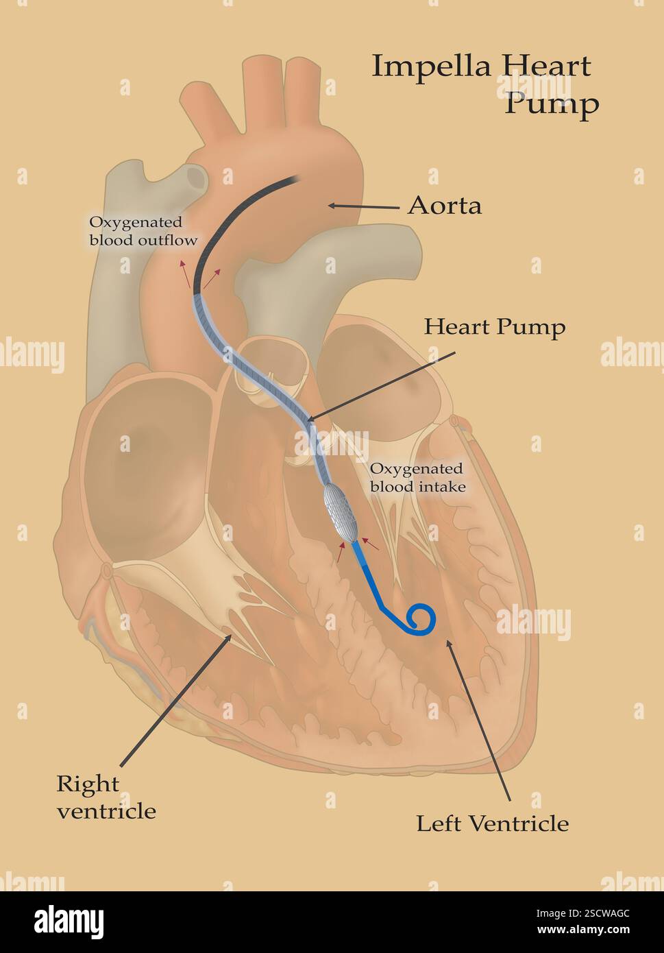 Impella heart pump shown in the left ventricle, Medical Illustration, Labeled Stock Photo - Alamy