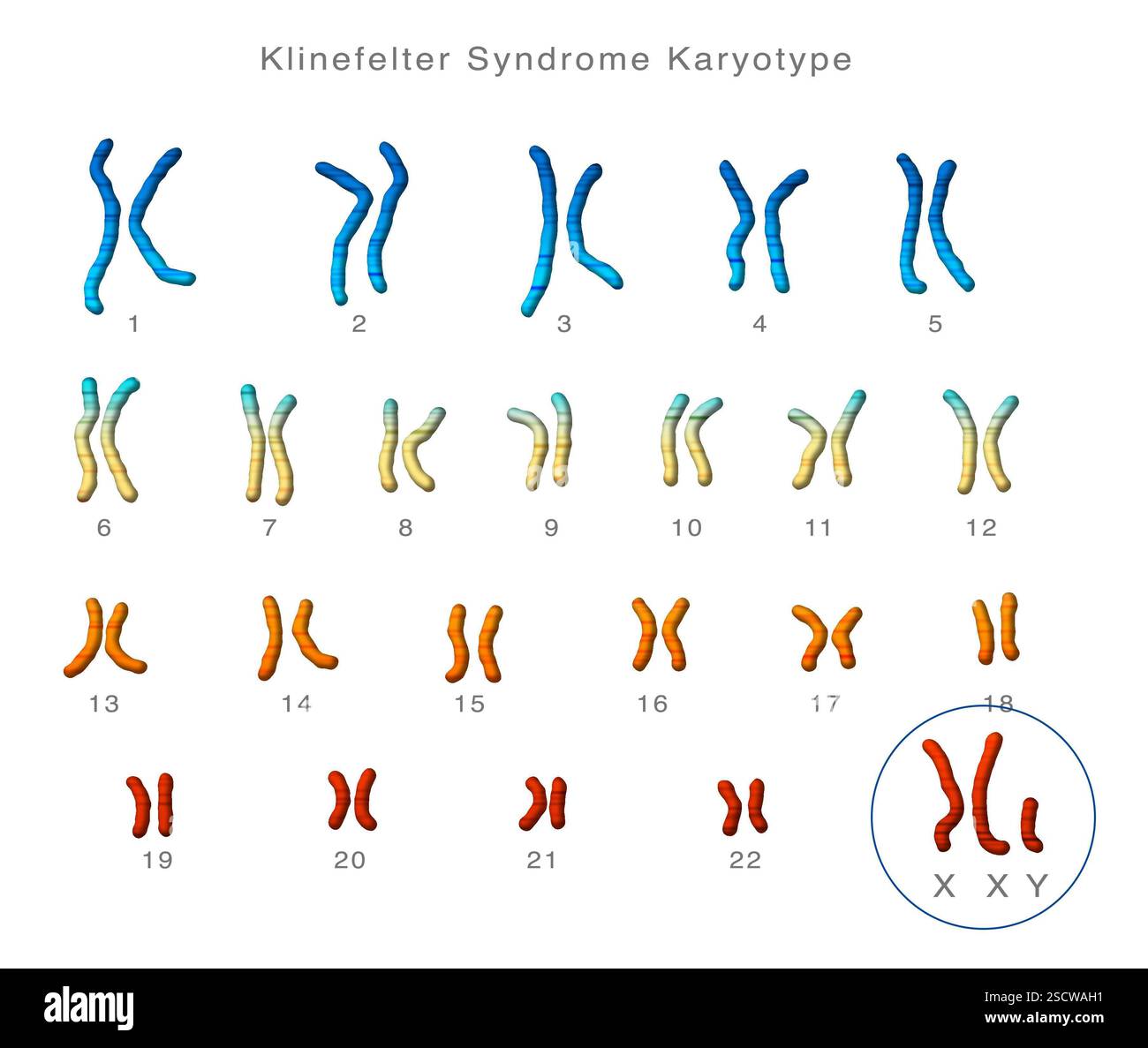 Klinefelter syndrome karyotype hi-res stock photography and images - Alamy