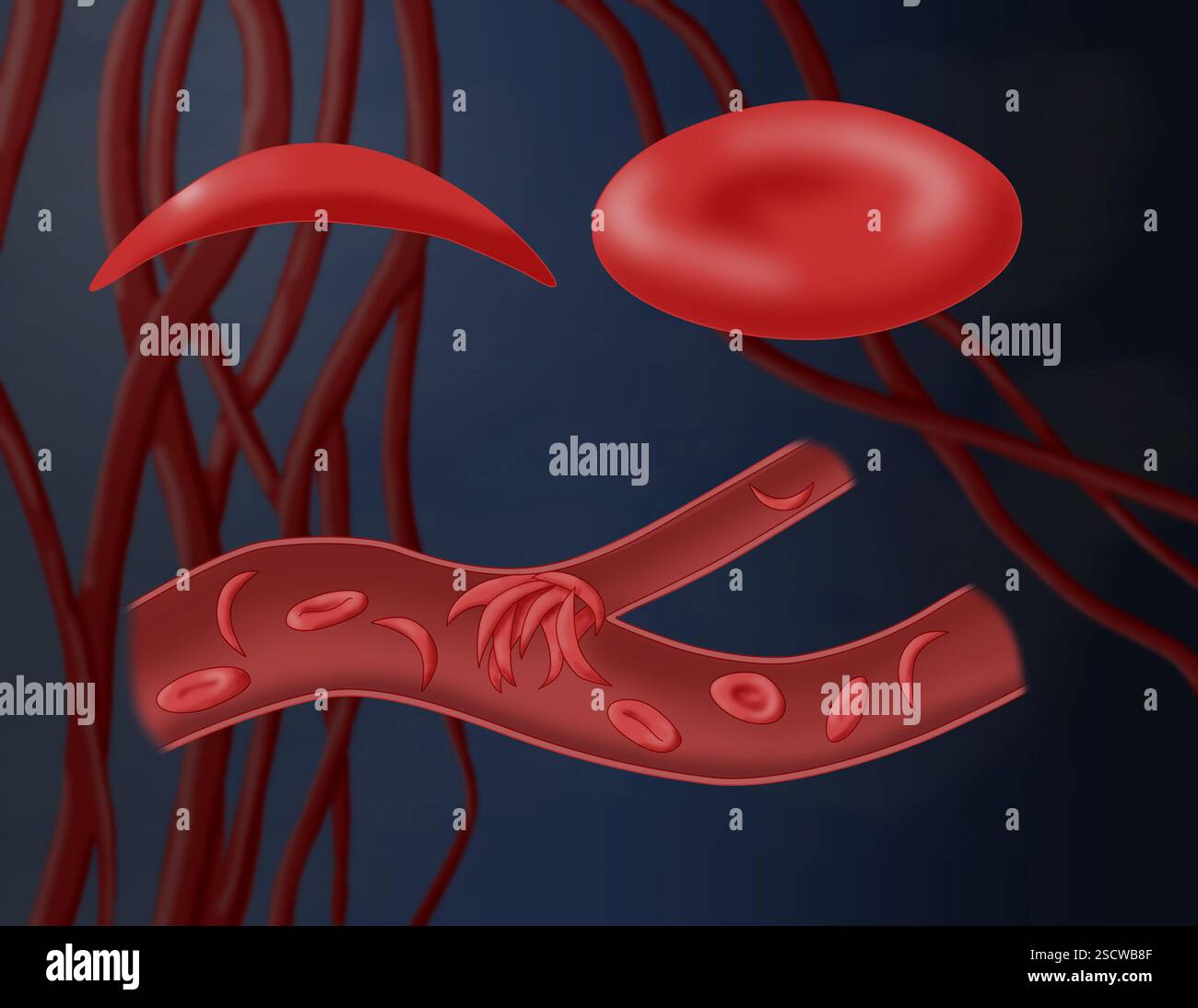 Sickle Cell Disease is a recessive genetic disorder. An illustration ...