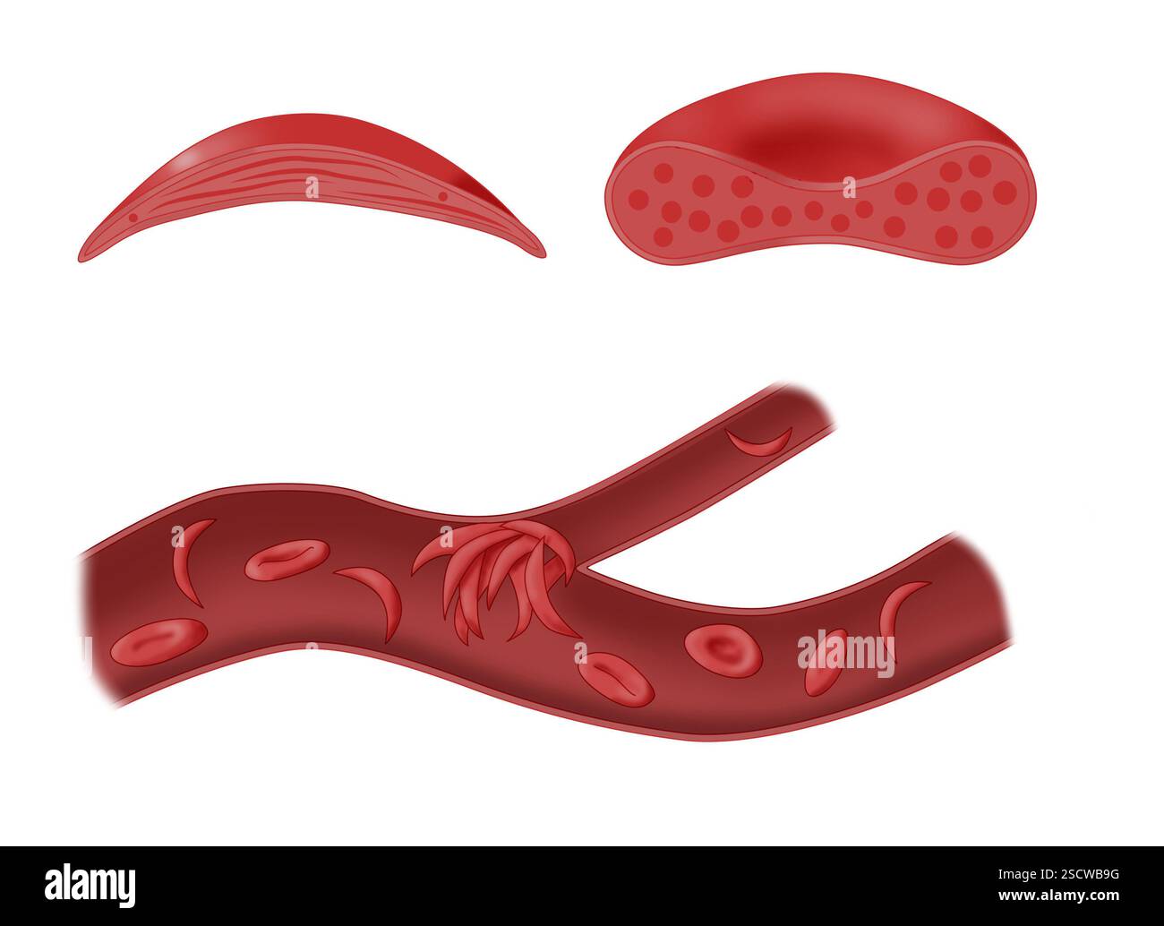 Normal and clogged artery hi-res stock photography and images - Alamy