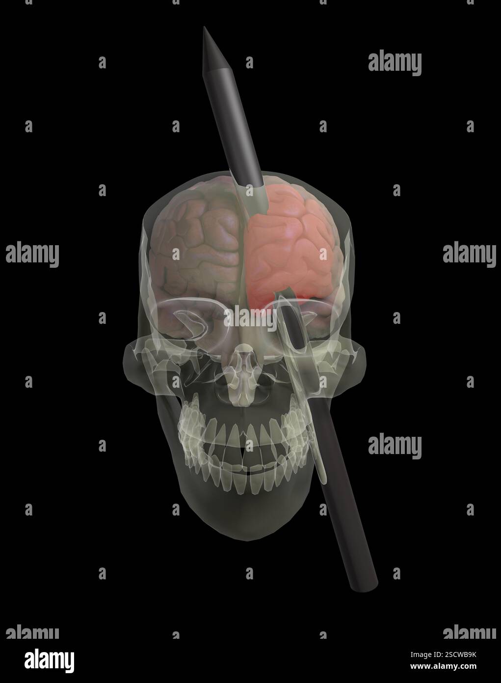 Phineas gage hi-res stock photography and images - Alamy