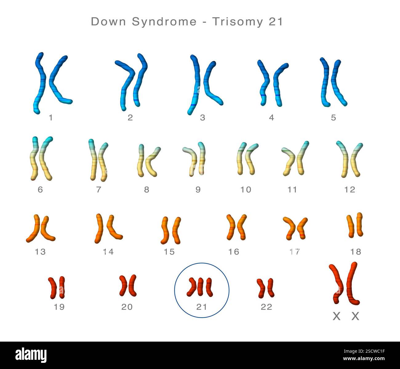 Karyotype of a woman with Down's Syndrome (trisomy 21), showing an additional twenty-first ...