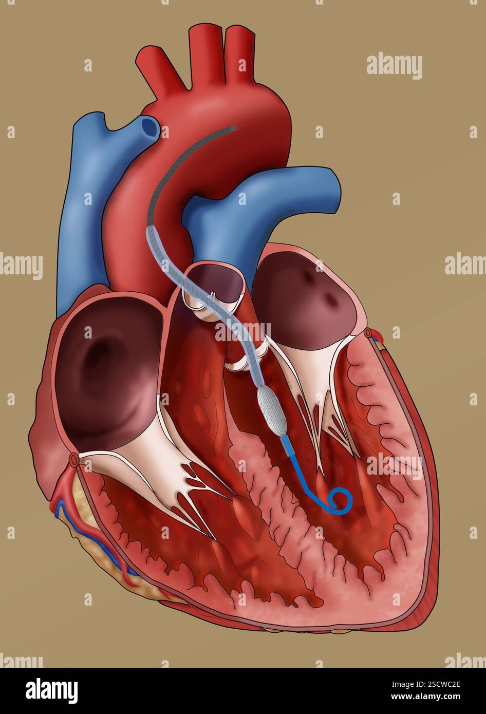 An illustration depicting the placement and positioning of the Impella ...
