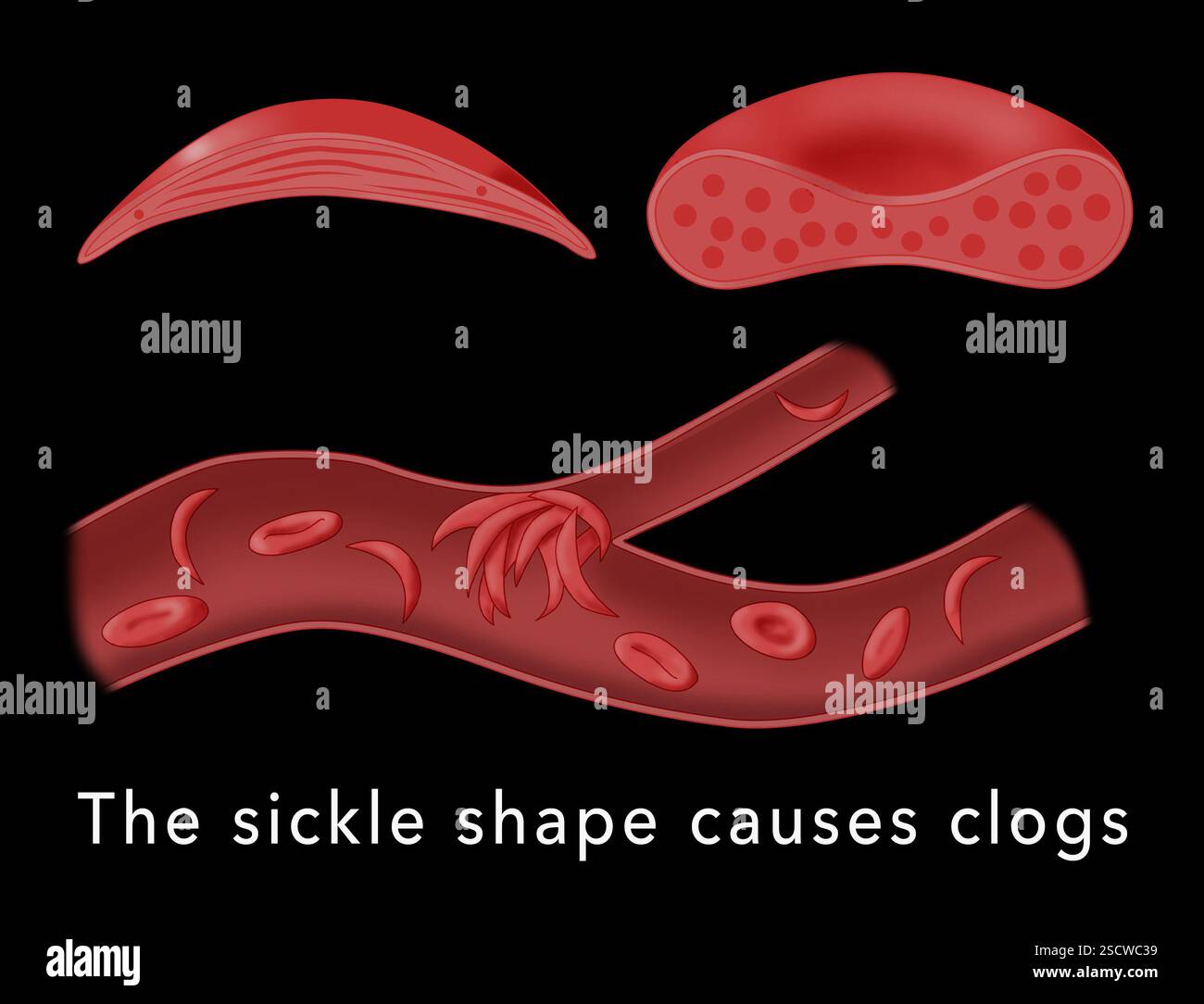 Sickle Cell Disease is a recessive genetic disorder. An illustration ...