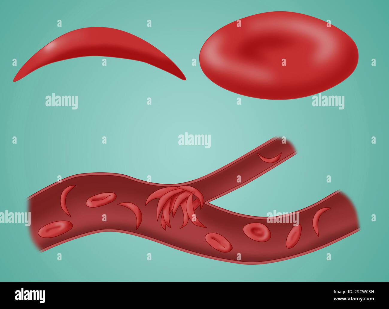 Sickle Cell Disease is a recessive genetic disorder. An illustration ...