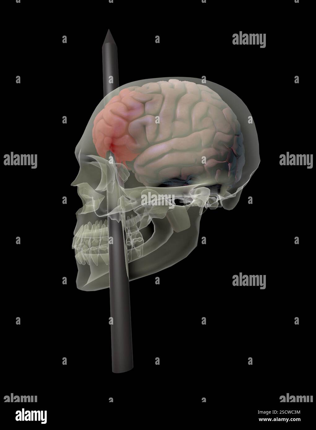 Phineas Gage (July 1823-May 1860) was an American railroad worker known ...
