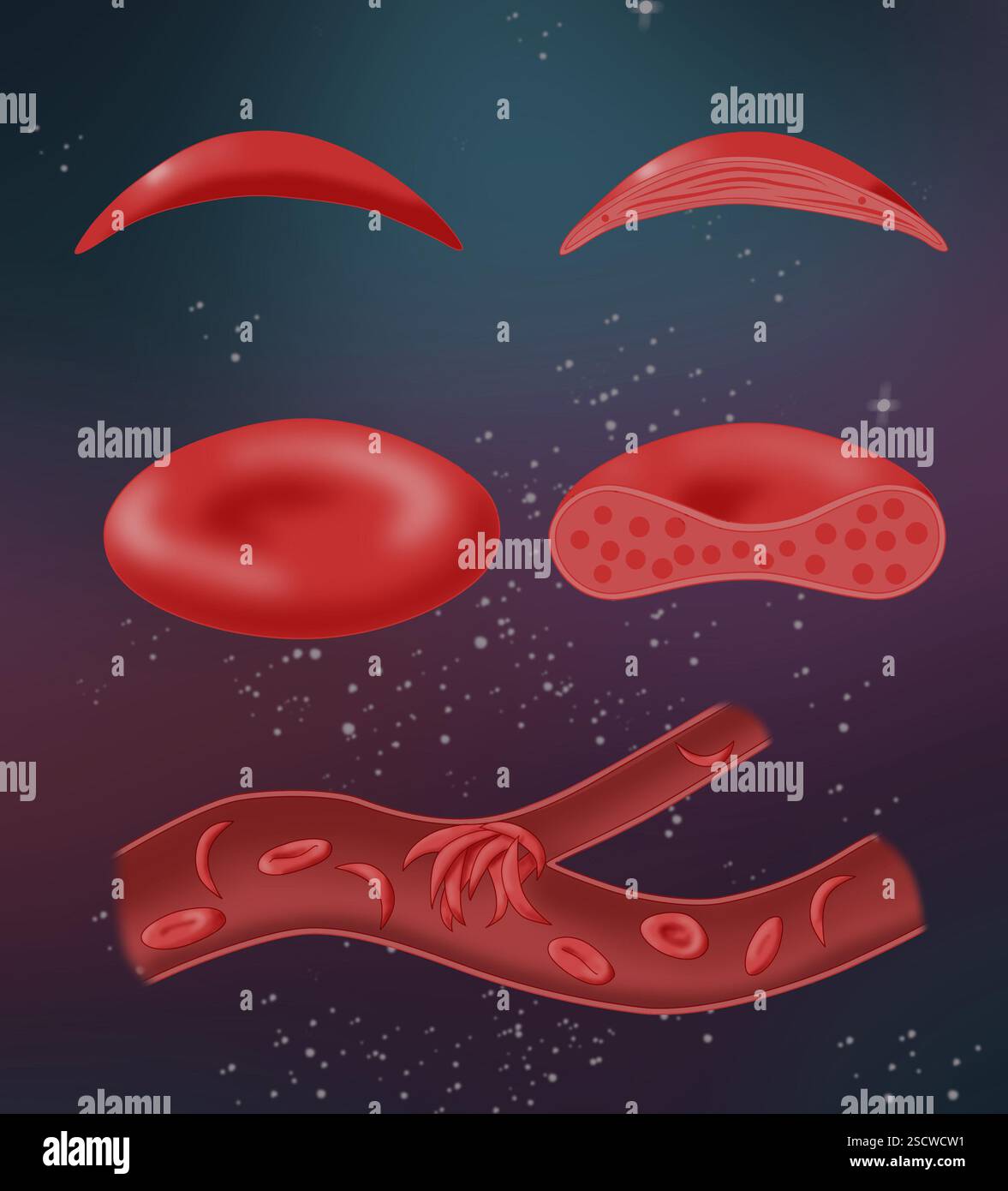 Normal and clogged artery hi-res stock photography and images - Alamy