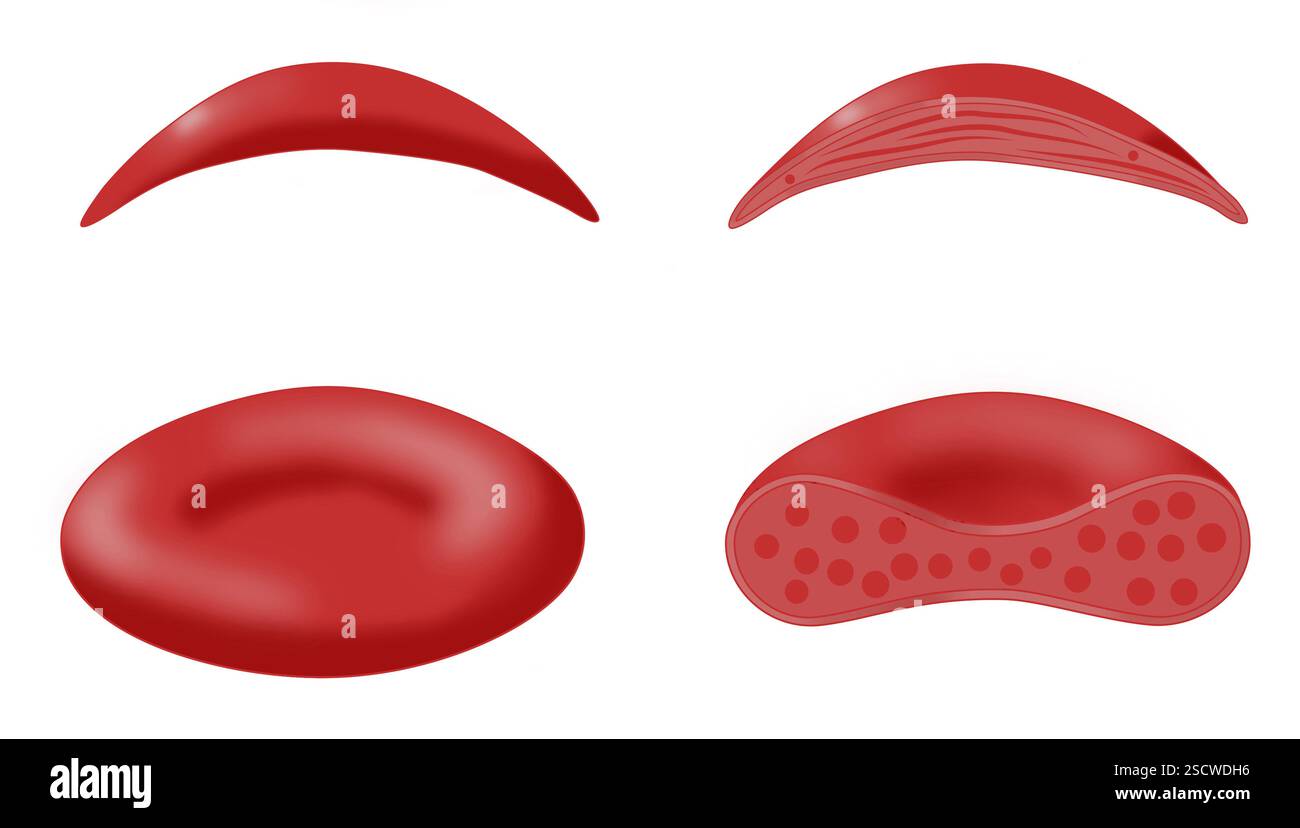Sickle Cell Disease is a recessive genetic disorder. An illustration ...