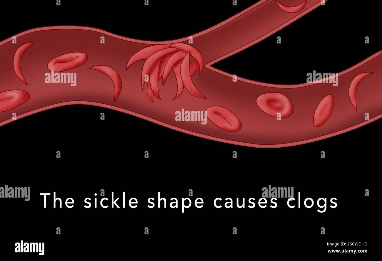 Sickle Cell Disease is a recessive genetic disorder. AN illustration of ...