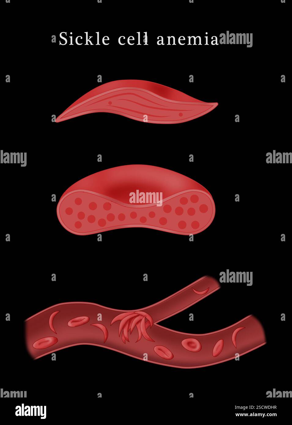 Sickle Cell Disease is a recessive genetic disorder. An illustration ...