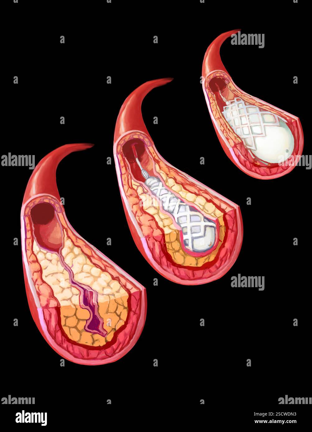 When an artery becomes clogged a "stent" can be inserted in the lumen ...