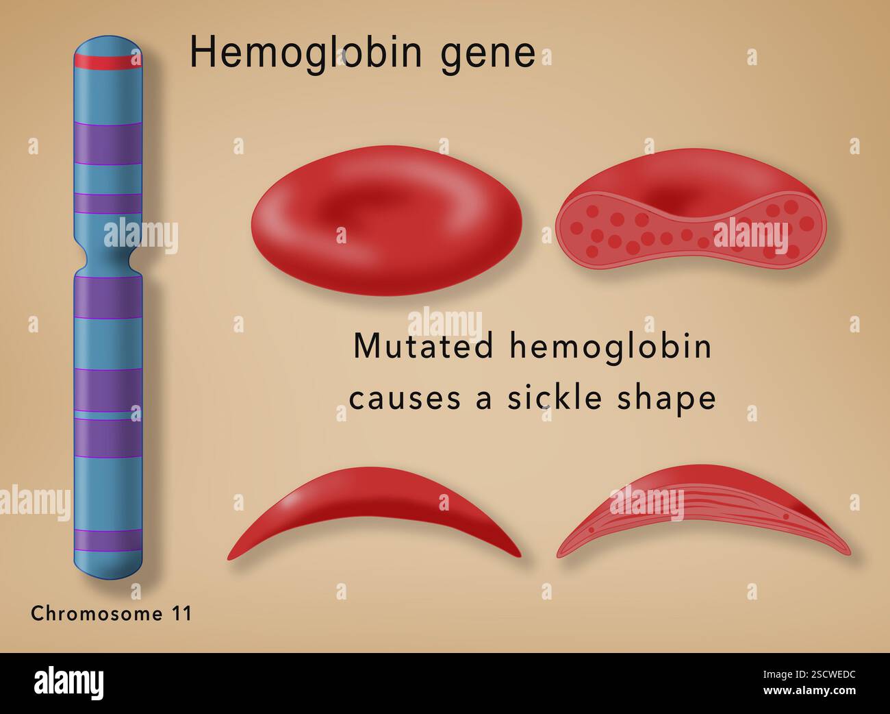 Sickle Cell Disease is a recessive genetic disorder. An illustration ...