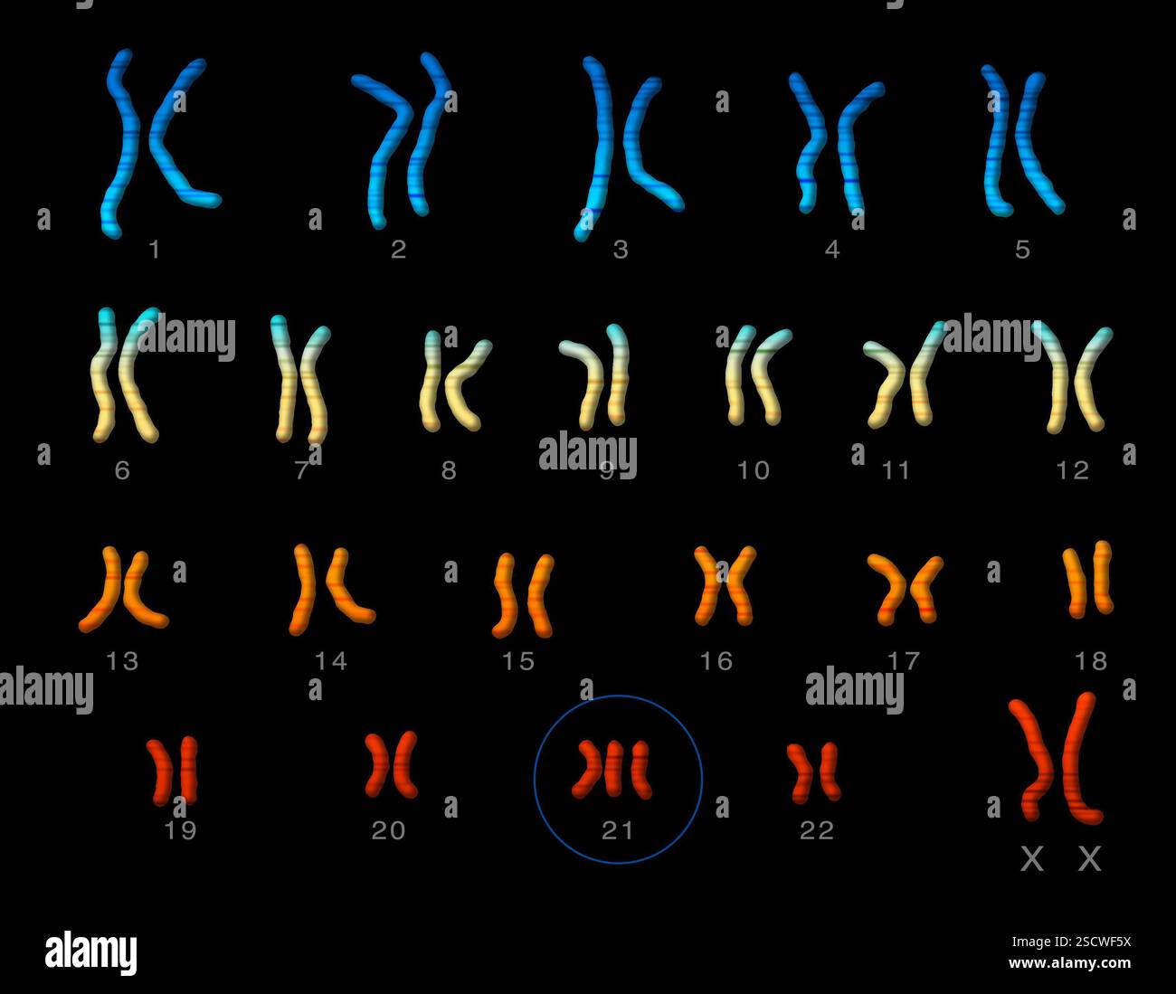 Karyotype of a woman with Down's Syndrome (trisomy 21), showing an additional twenty-first ...