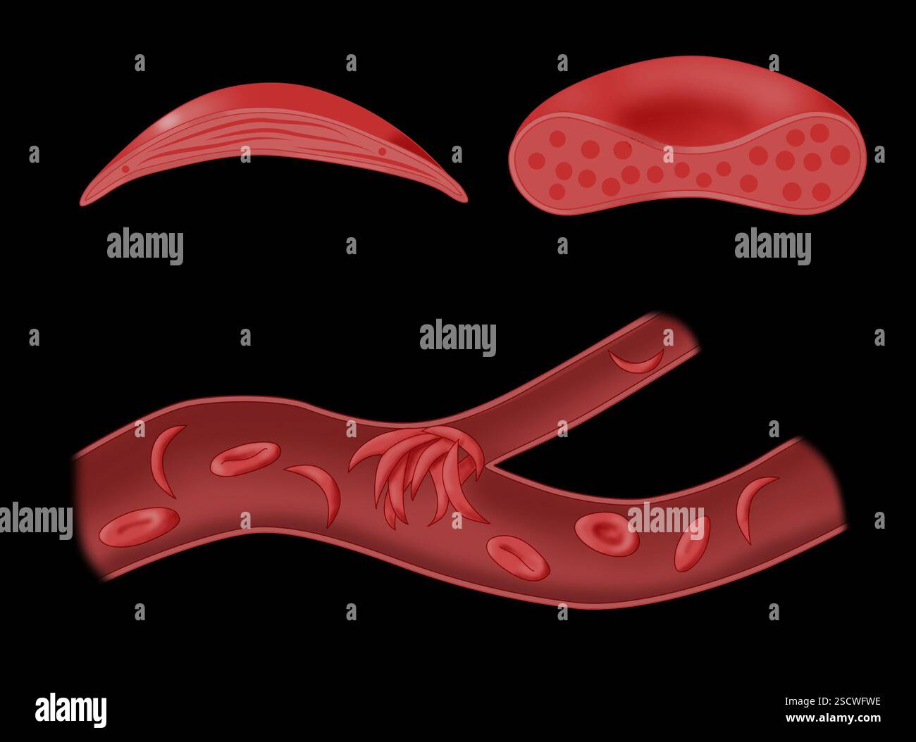 Sickle Cell Disease is a recessive genetic disorder. An illustration ...