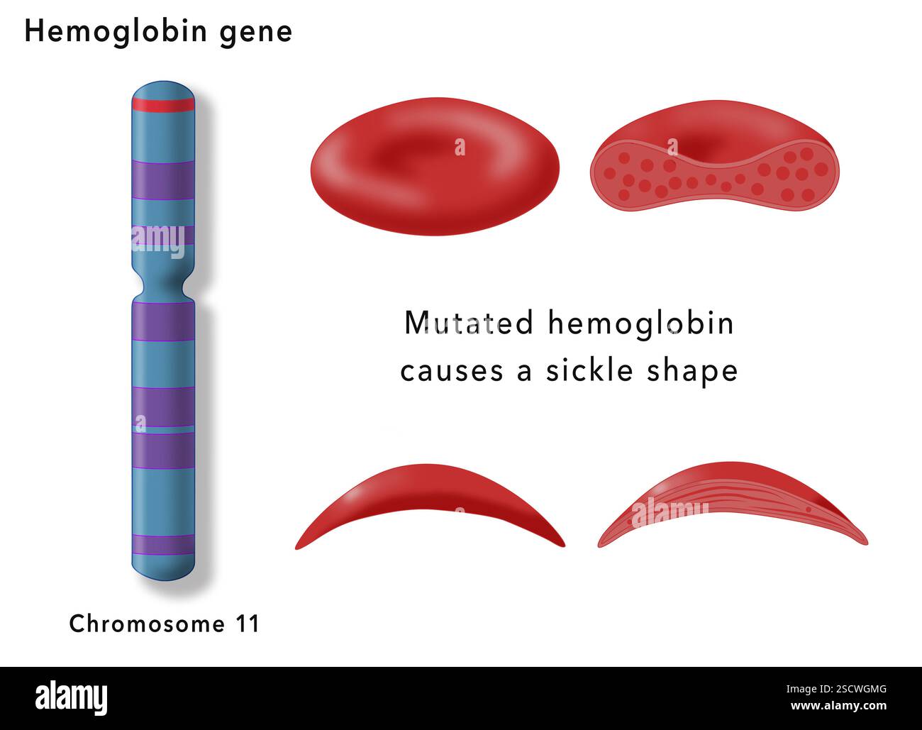 Sickle Cell Disease is a recessive genetic disorder. An illustration ...