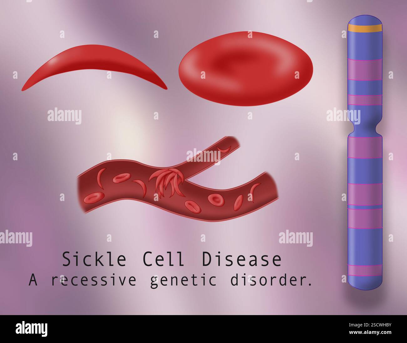 Sickle Cell Disease is a recessive genetic disorder. An illustration ...