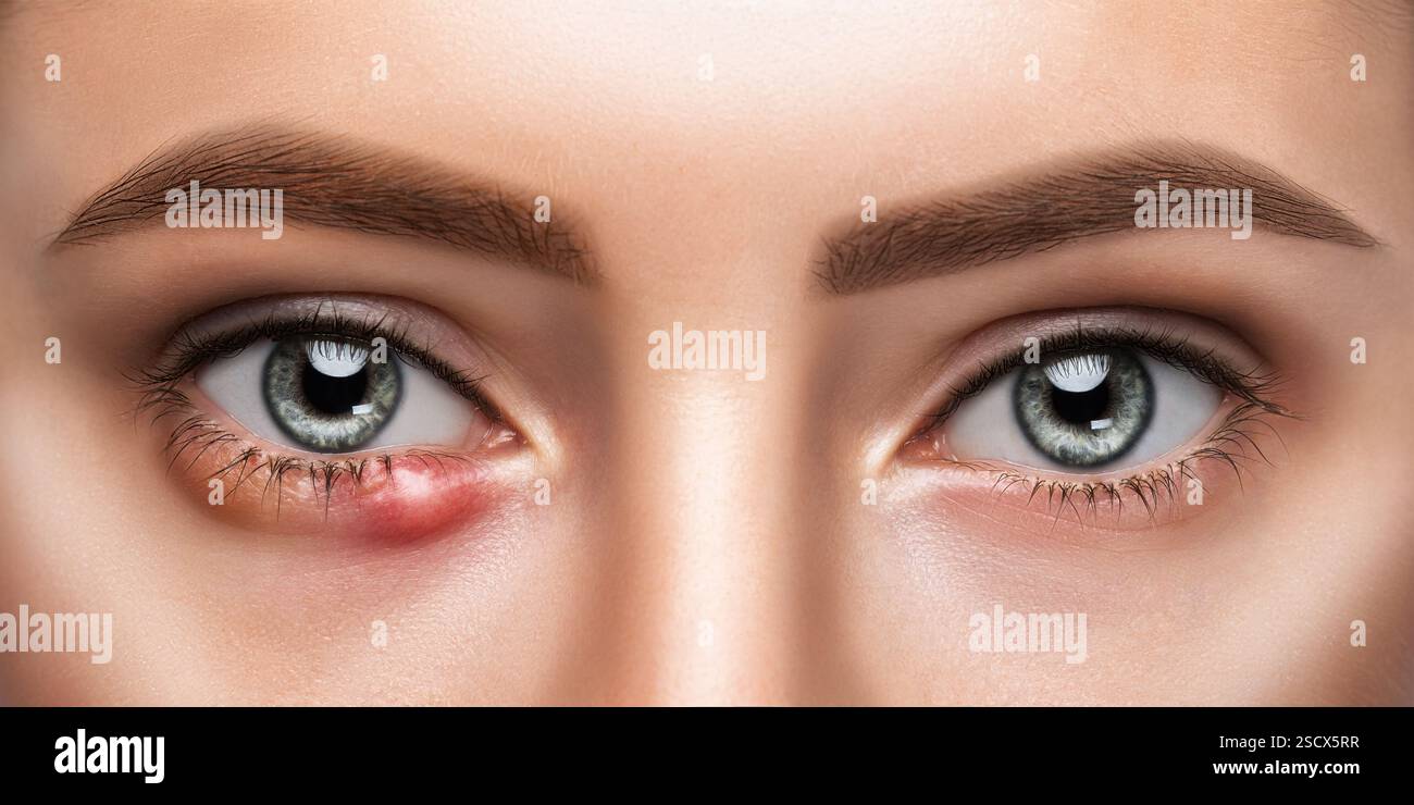 Eyes of a girl with stye close-up. Acute purulent inflammation of the ...