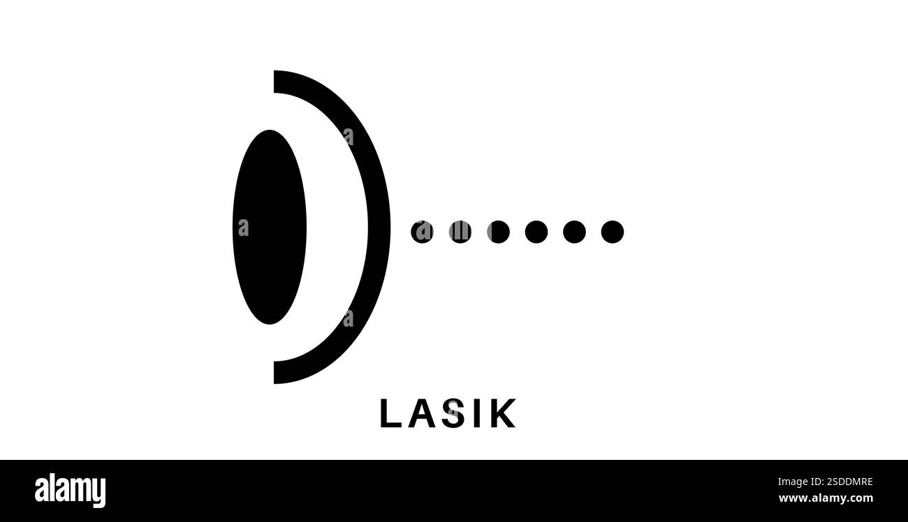 Illustration of LASIK (Laser-Assisted In Situ Keratomileusis) also ...