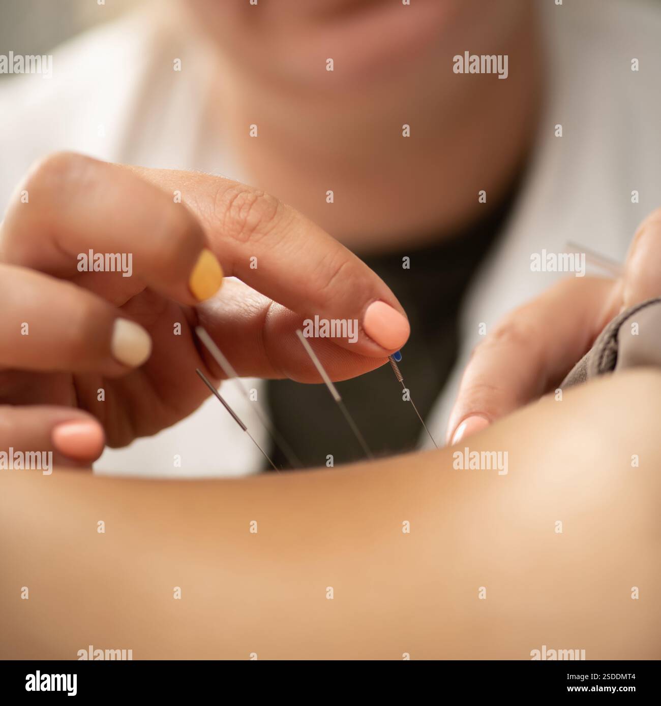 Acupuncture for lower back pain Stock Photo - Alamy