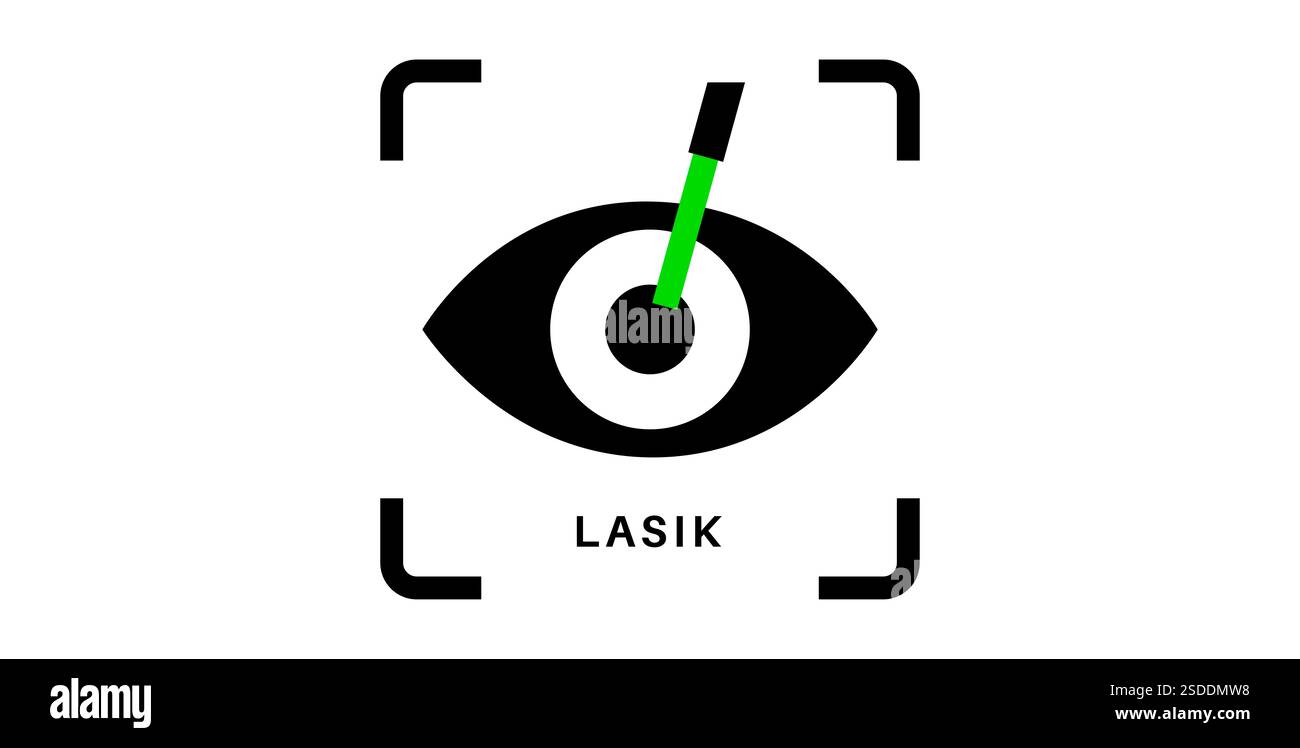 Illustration of LASIK (Laser-Assisted In Situ Keratomileusis) also ...