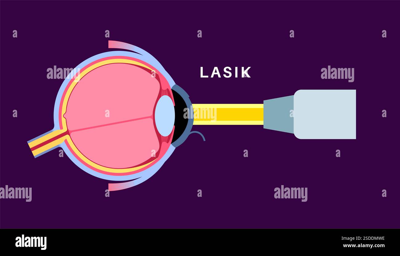 Illustration of LASIK (Laser-Assisted In Situ Keratomileusis) also ...