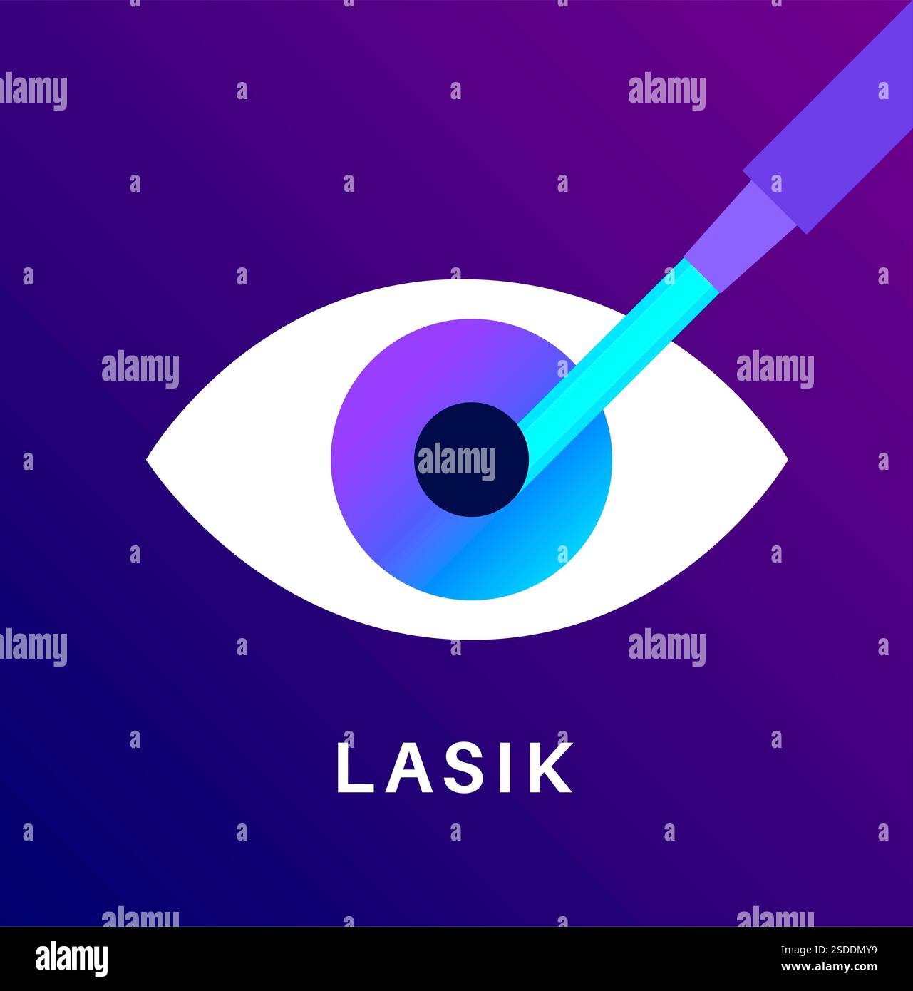 Illustration of LASIK (Laser-Assisted In Situ Keratomileusis) also ...