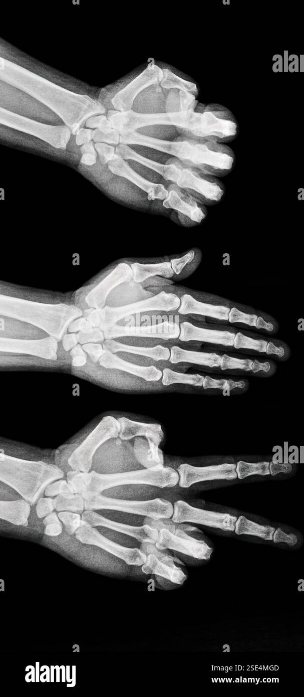 Film xray x-ray or radiograph of Rock paper scissors, a hand game ...