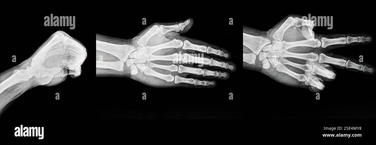 Film xray x-ray or radiograph of Rock paper scissors, a hand game ...