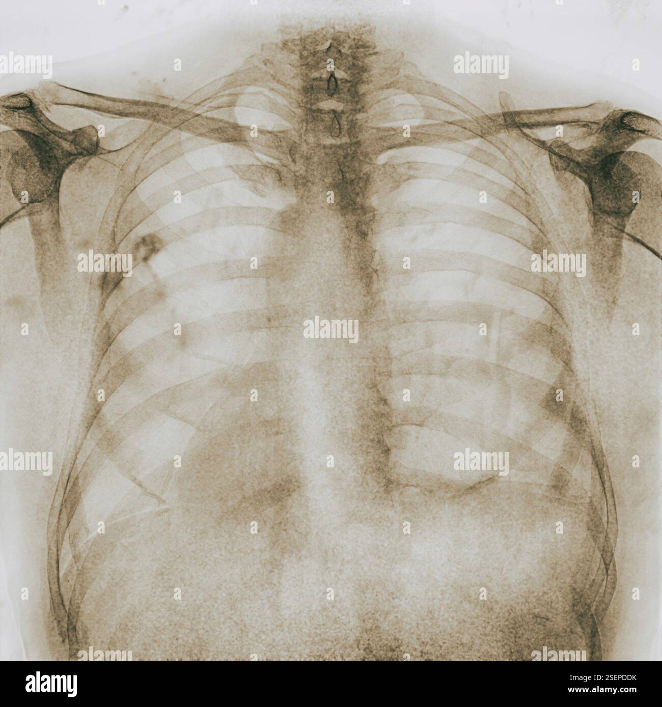 X-ray image of the human chest TB screening Stock Photo - Alamy