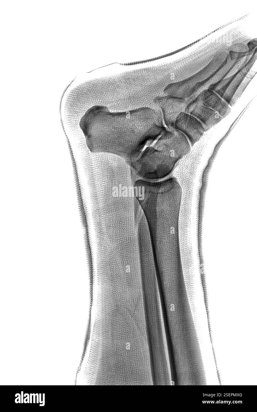 Foot x ray hi-res stock photography and images - Alamy