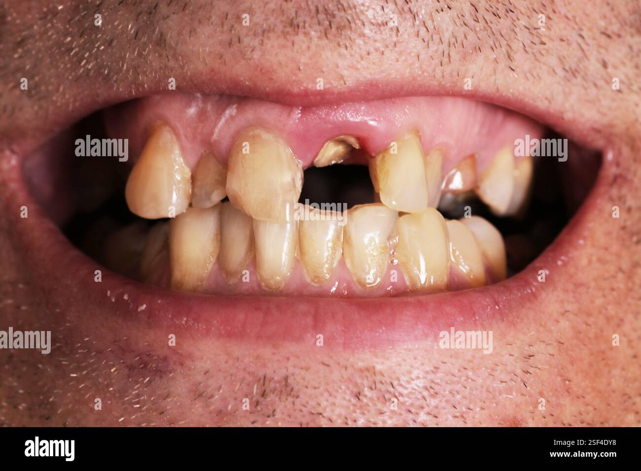 Close-up of an open mouth with crooked, sick teeth. Dental disease ...