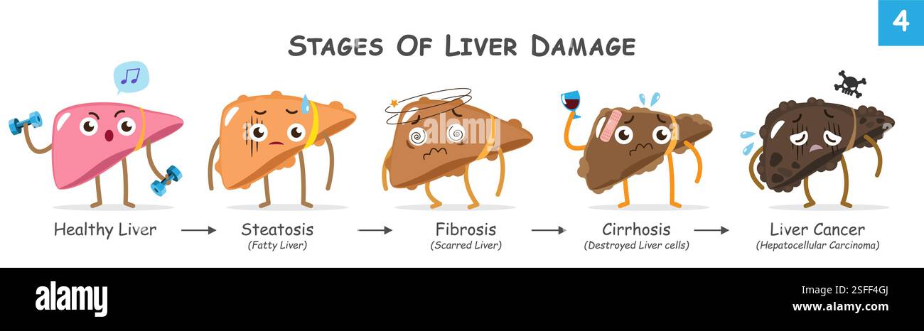Stages of liver damage . Collection of cute medical cartoon characters ...