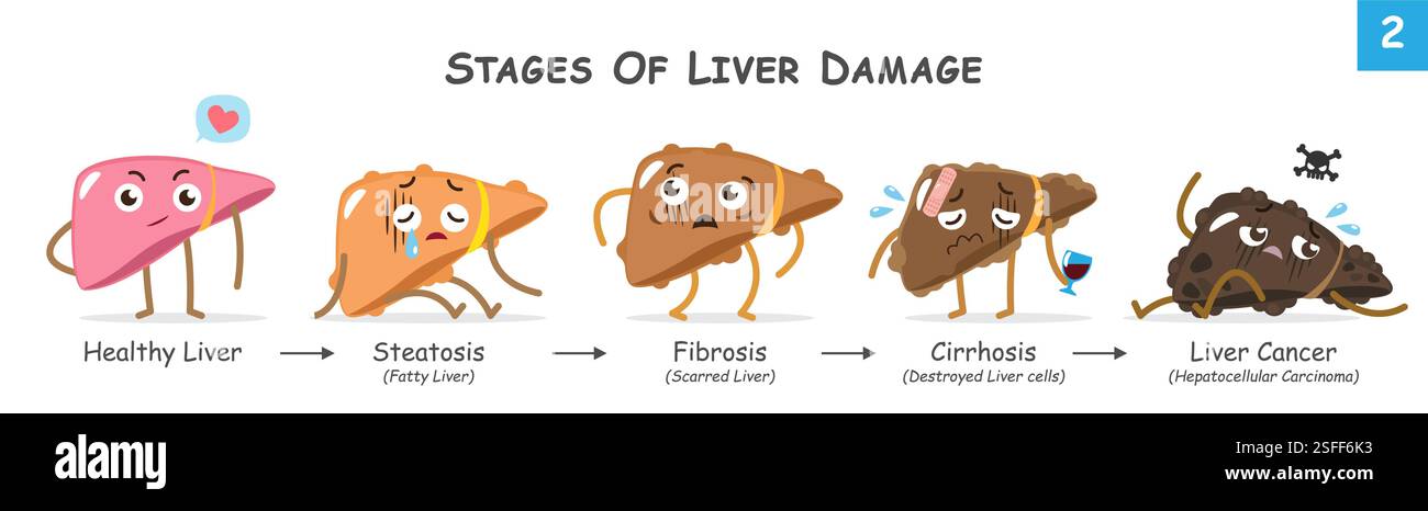 Stages of liver damage . Collection of cute medical cartoon characters ...