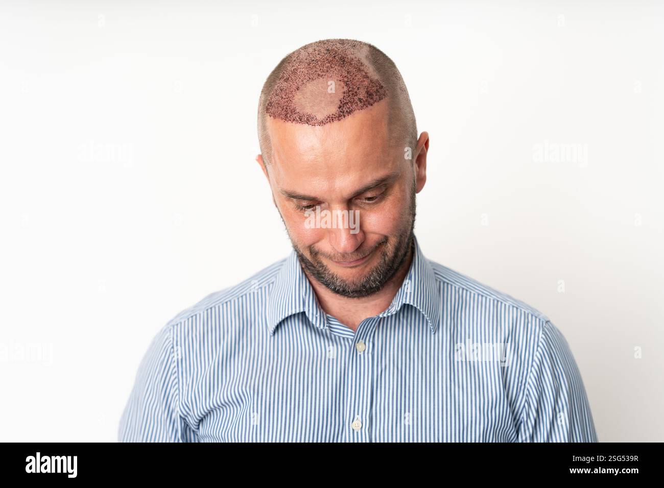 Sad Man Looking Disappointed After Hair Transplant Surgery Stock Photo ...