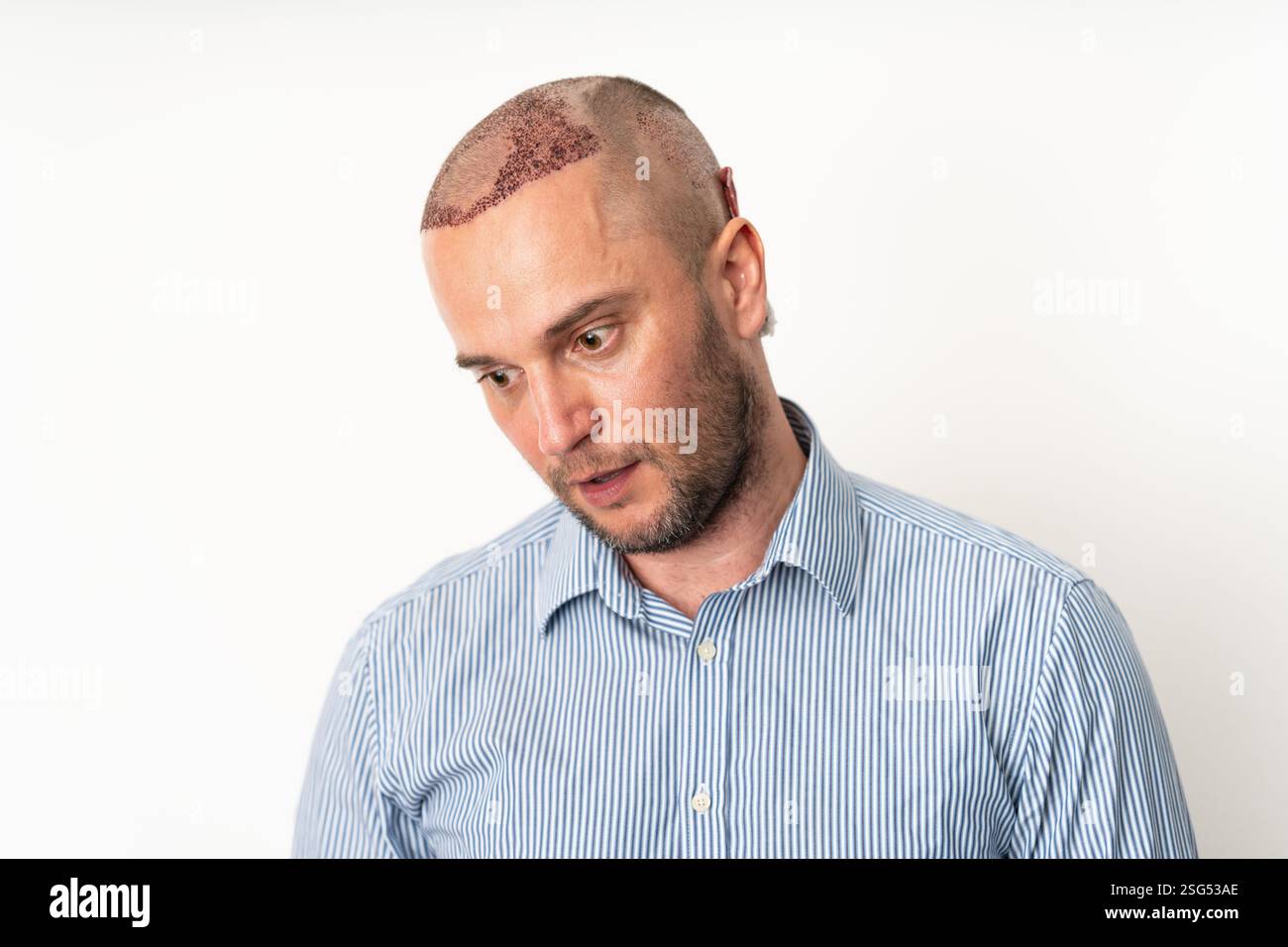 Frustrated Man in Recovery After Hair Restoration Surgery Stock Photo ...