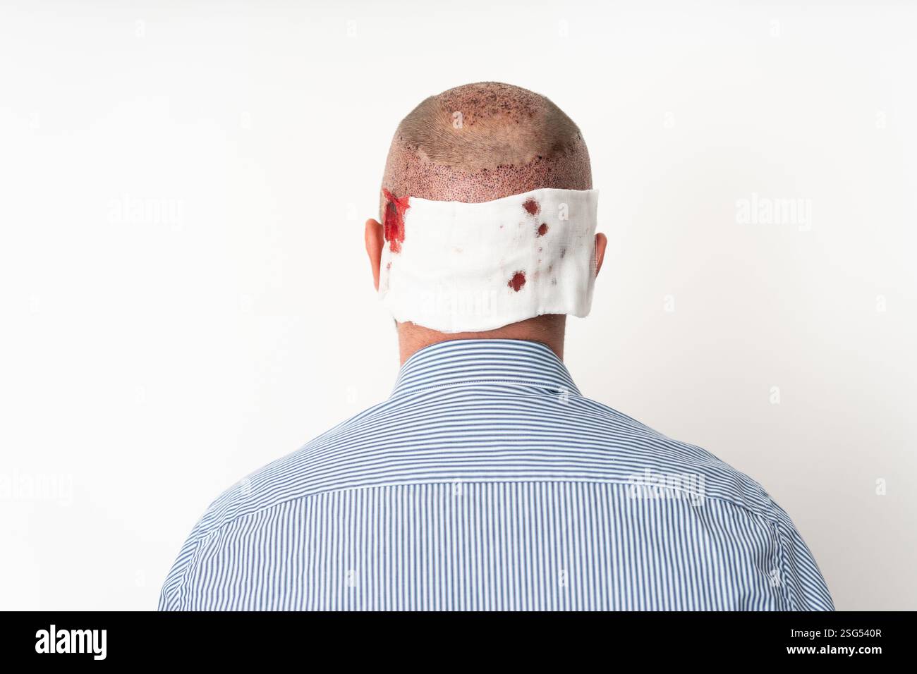 Back View of a Man in a Blue Shirt with Fresh Surgical Scars and Blood ...