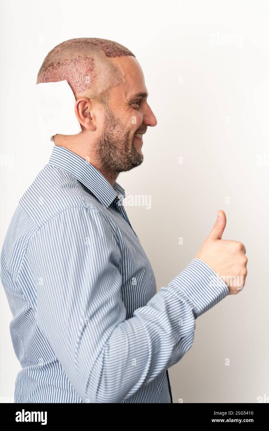 Happy Man Giving Thumbs Up After Hair Transplant Surgery Stock Photo ...