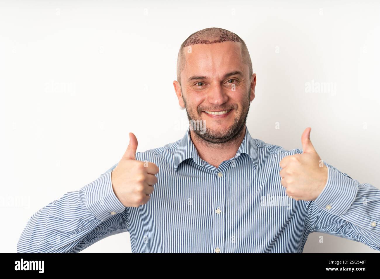 Happy Man Giving Thumbs Up After Hair Transplant Surgery Stock Photo ...