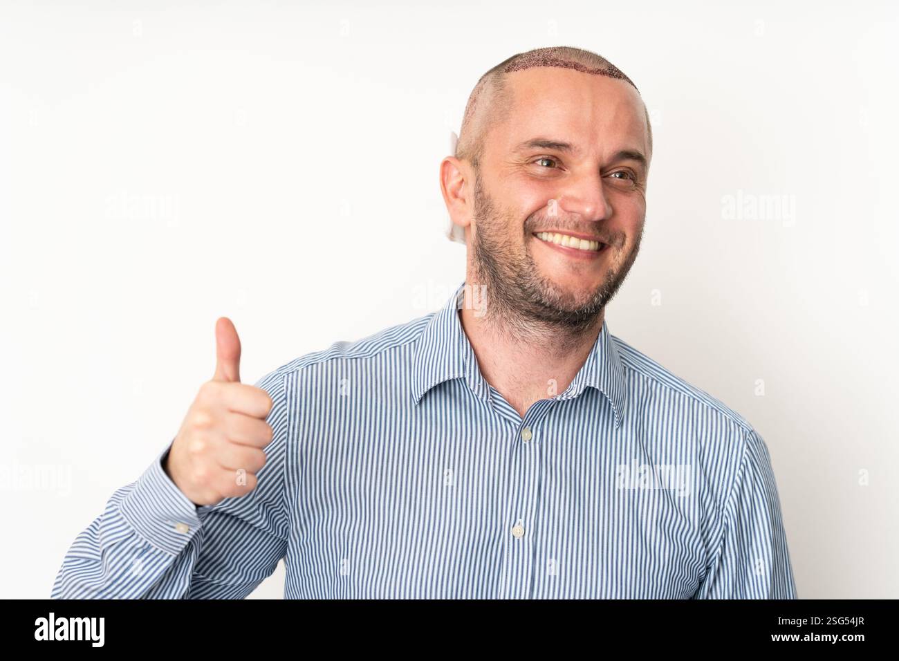 Happy Man Giving Thumbs Up After Hair Transplant Surgery Stock Photo ...