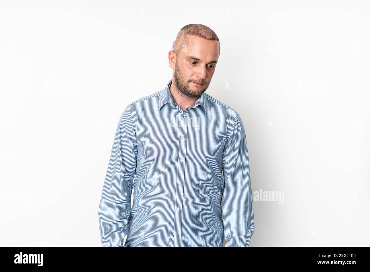 Sad Man Looking Disappointed After Hair Transplant Surgery Stock Photo ...