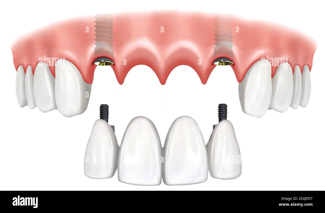 Schematic Illustration of the procedure of a dental bridge implant and ...