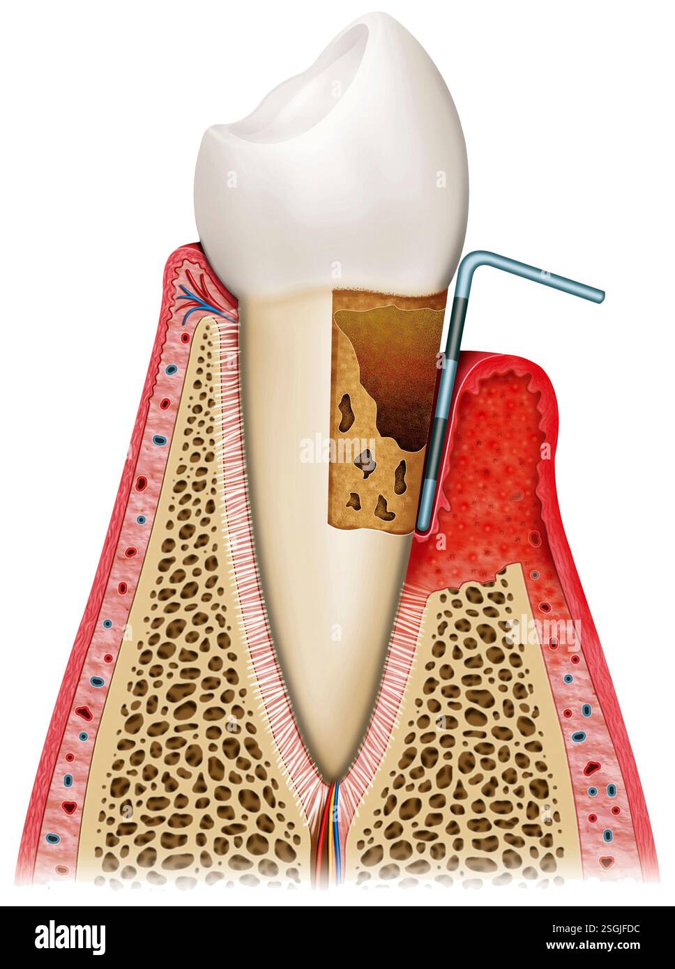 Representation of a tooth affected by periodontal disease (gingivitis ...