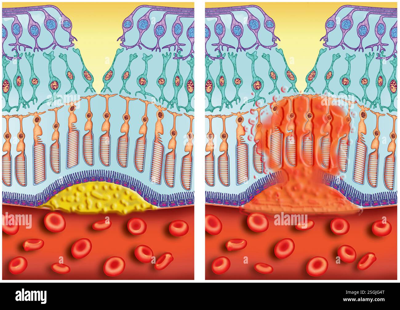 Diagram of the (AMD) eye disease. Age-related macular degeneration ...
