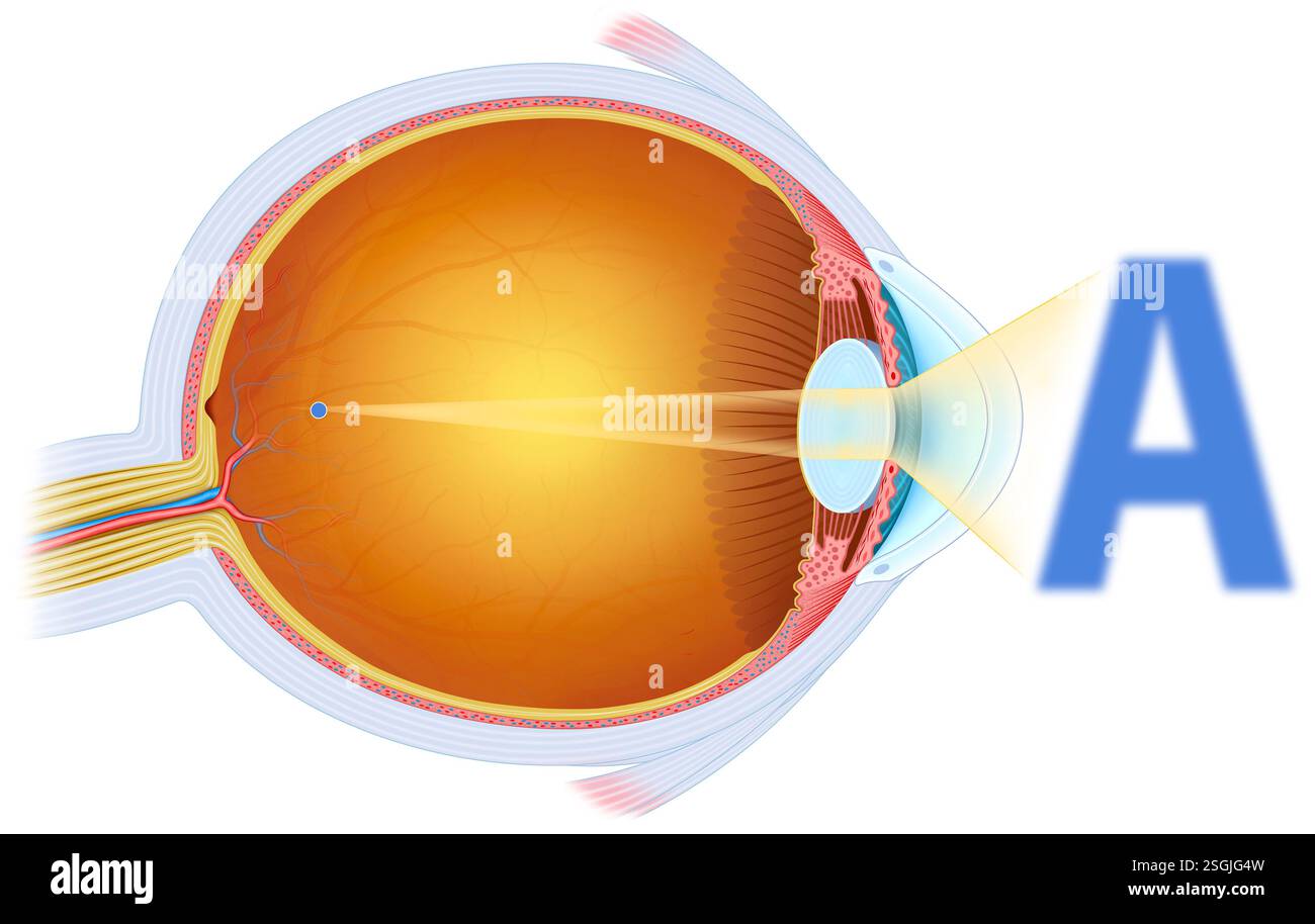 Illustration of visual focus with myopia. Difficulty seeing distant ...